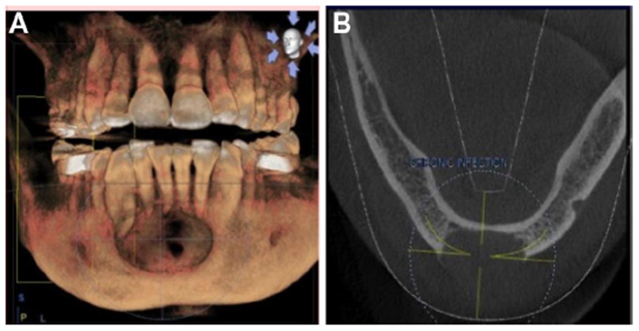 CBCT Interpretation - Diagnosing Abnormalities | Cavendish Imaging
