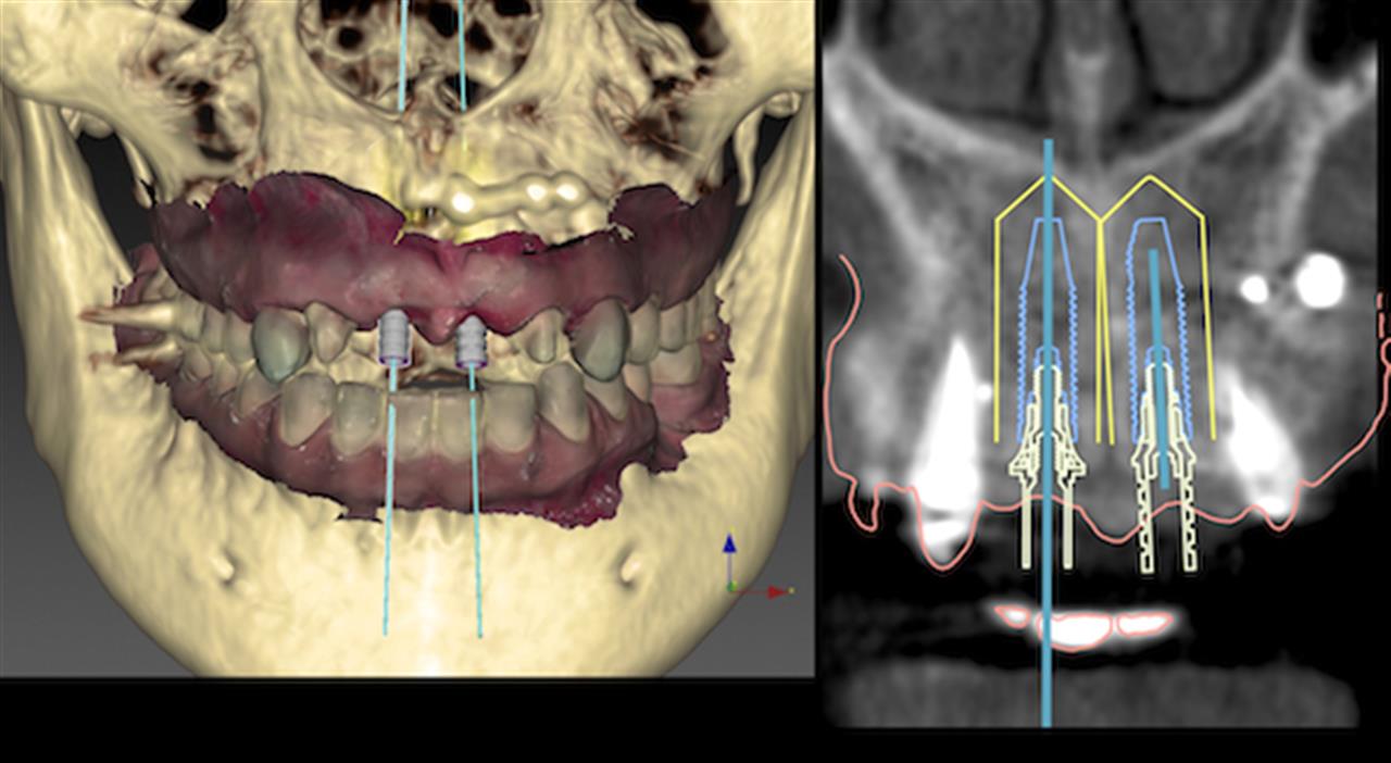 Dental CBCT for Implants | Cavendish Imaging