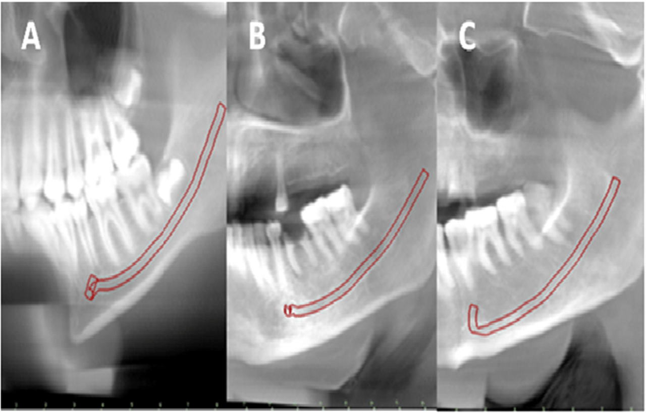 Limitations of 2D Imaging in Oral Surgery | Cavendish Imaging