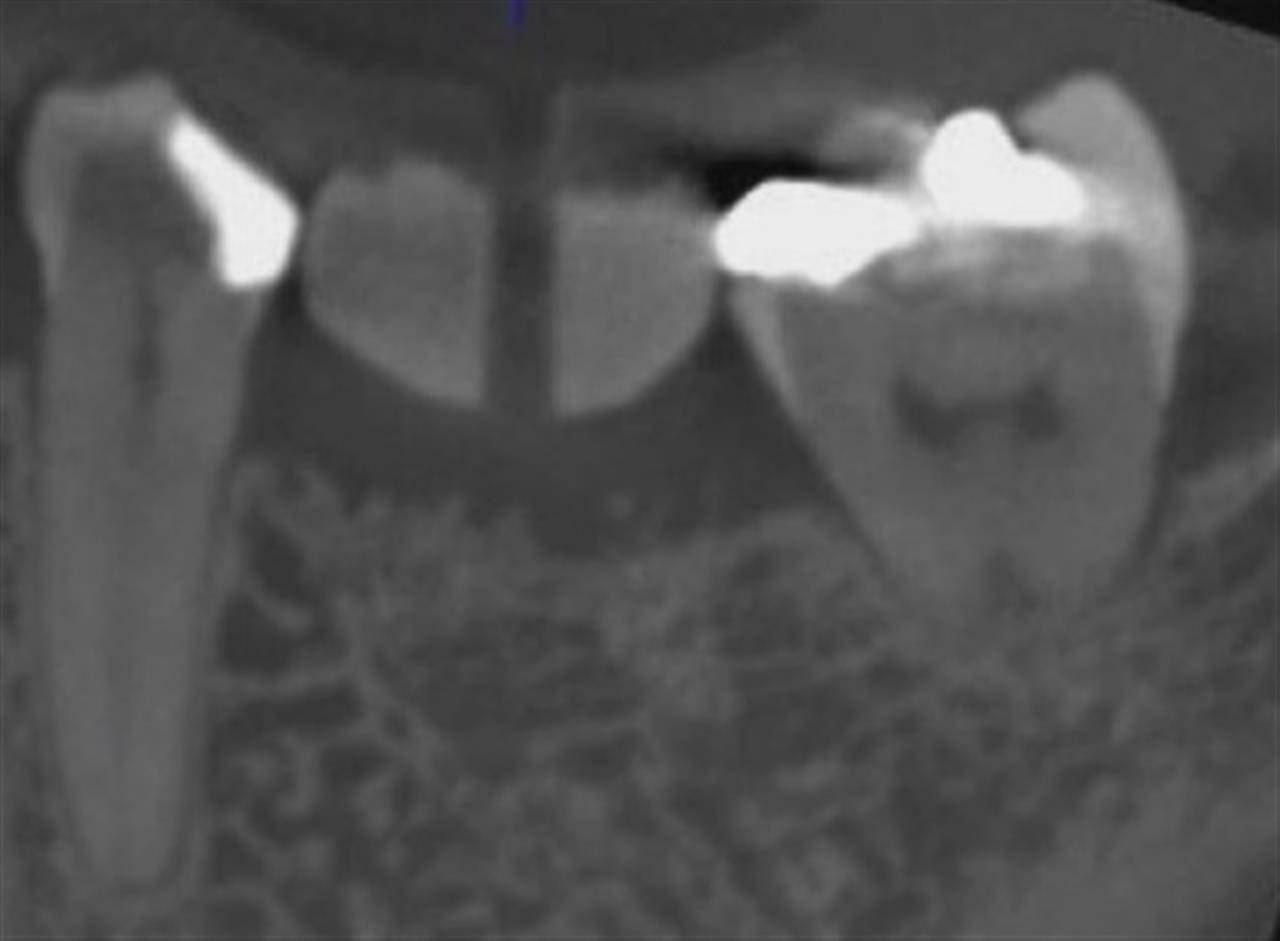 Planning for Guided Surgery: Constructing the Perfect Radiographic ...